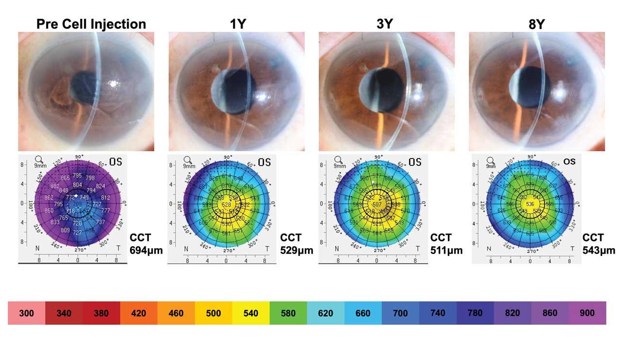 The Future of Corneal Transplantation | Ophthalmology Management