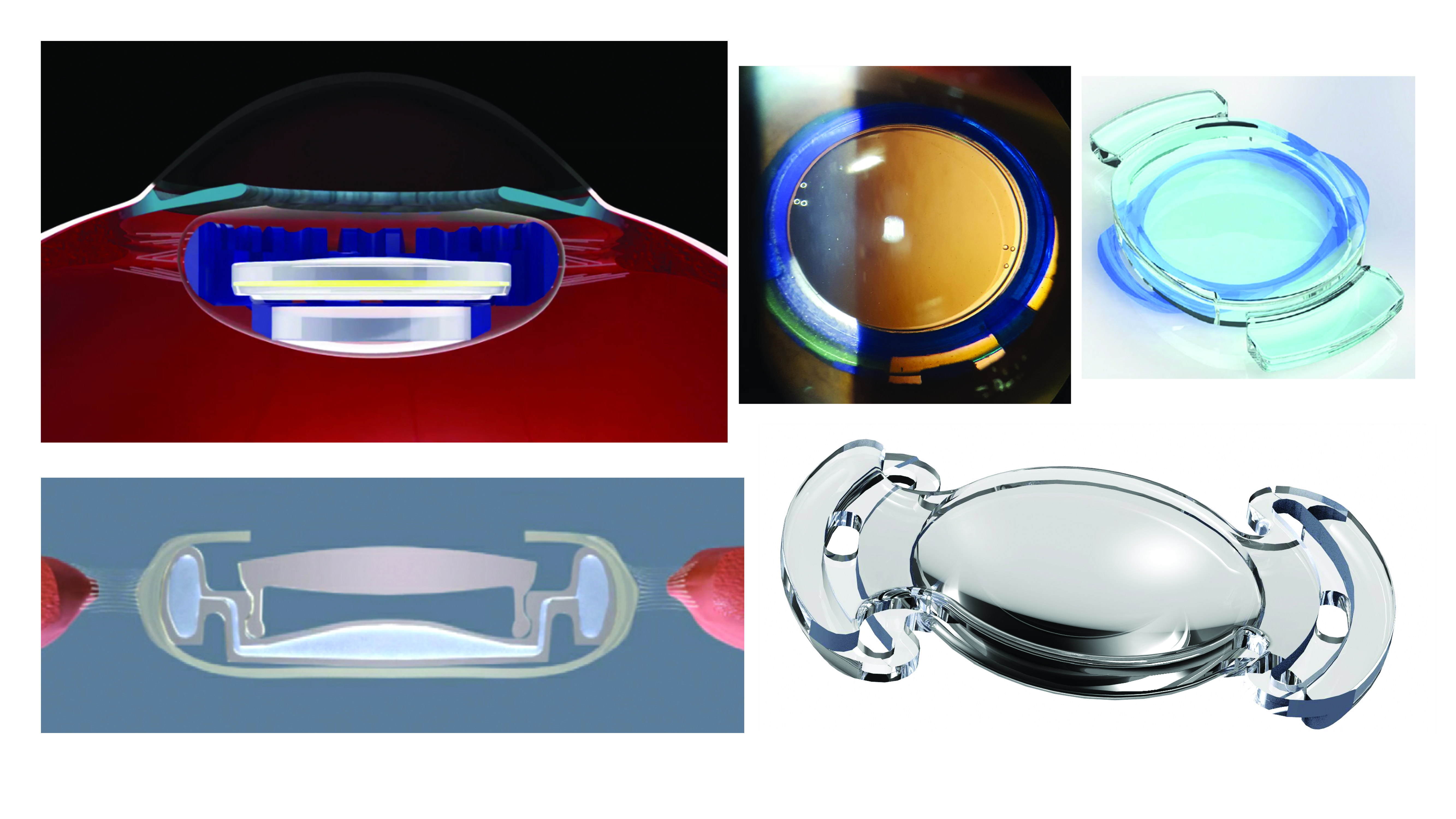 GET READY FOR TRULY ACCOMMODATING LENS IMPLANTS | Ophthalmology Management