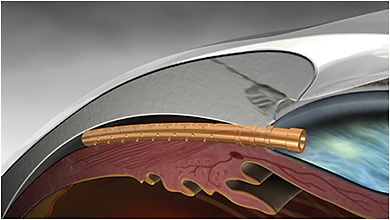 Ophthalmology Management | PentaVision